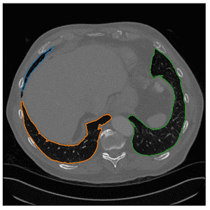 Introduction to medical image processing with Python: CT lung and ...