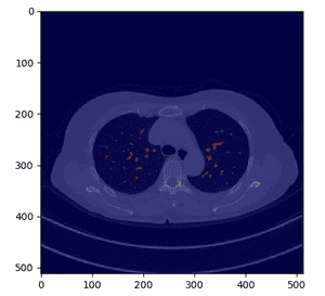 Introduction to medical image processing with Python: CT lung and ...