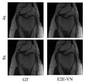 Deep learning in MRI beyond segmentation: Medical image reconstruction ...