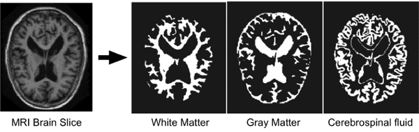 Deep learning in medical imaging - 3D medical image segmentation with ...