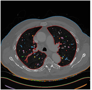 Introduction to medical image processing with Python: CT lung and ...