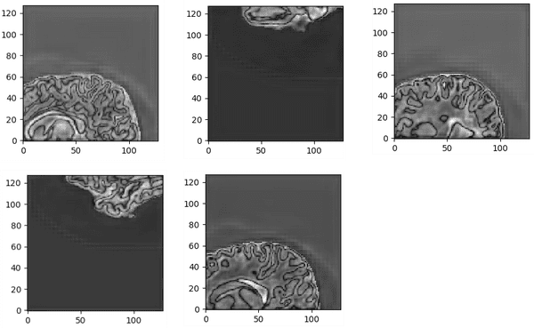 Deep learning in medical imaging - 3D medical image segmentation with ...