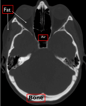 Introduction to medical image processing with Python: CT lung and ...